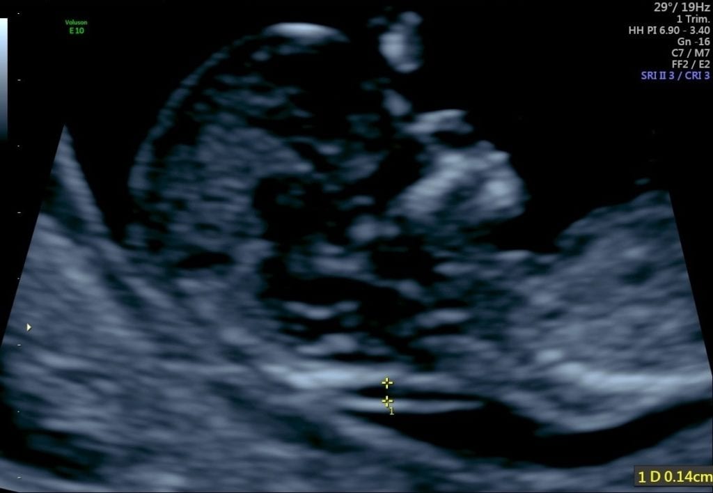 Cystic Hygroma: Definition, Genetics and Prognosis - The ObG Project