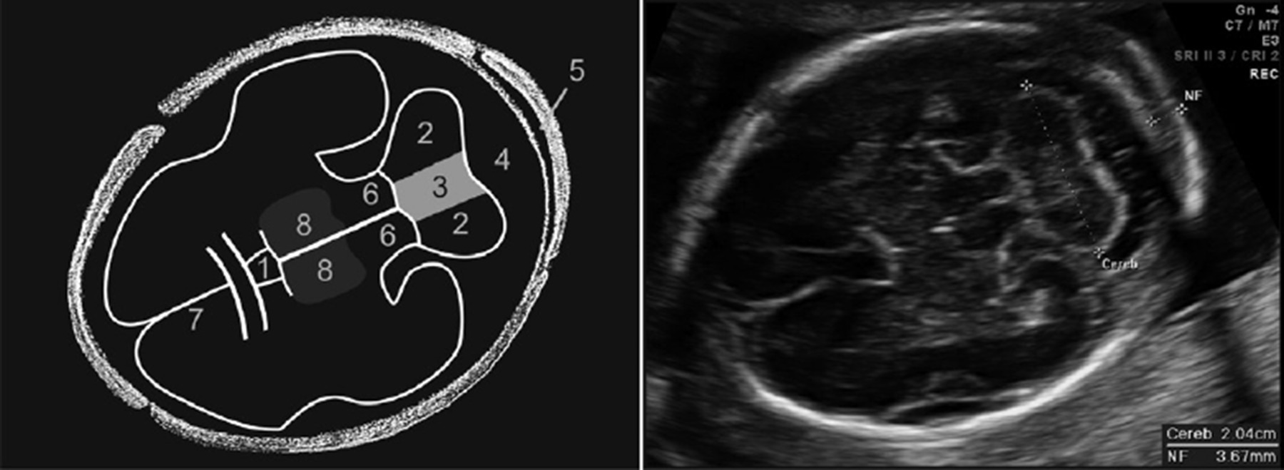 Fetal Head The ObG Project Fetal Head The ObG Project