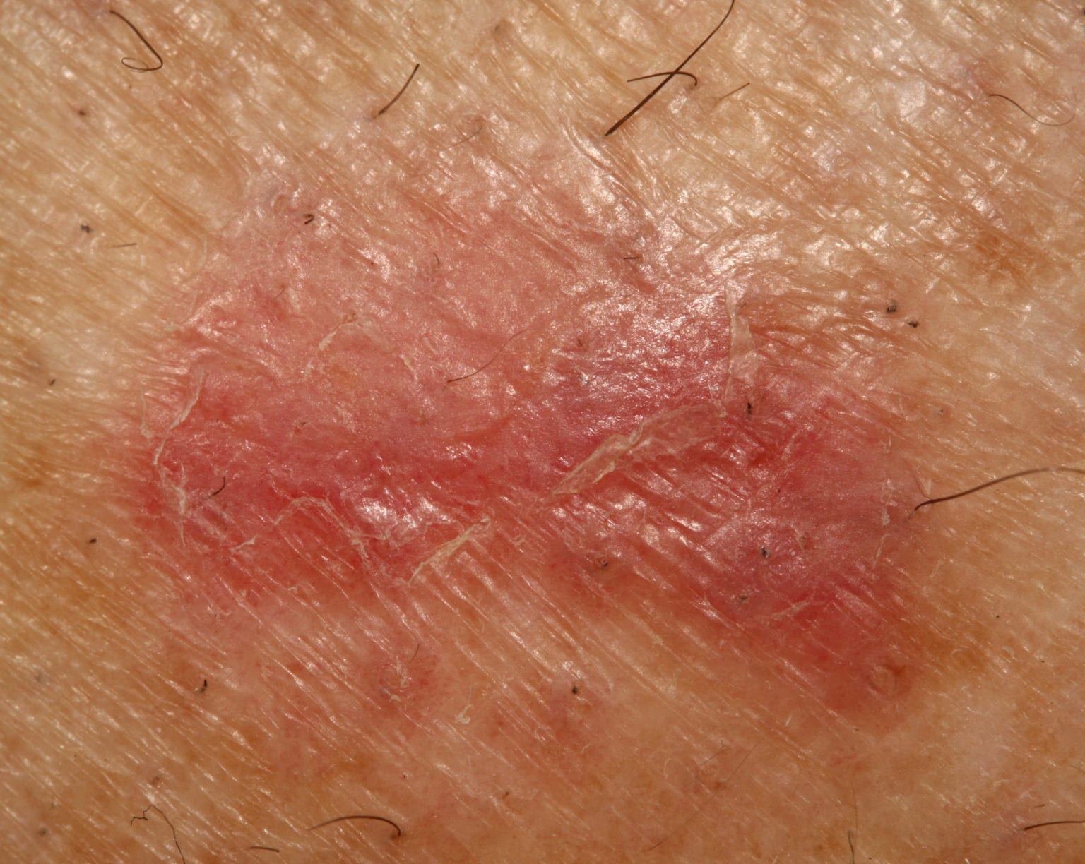 Basal Cell Carcinoma: Clinical Presentation and Management - The ObG ...